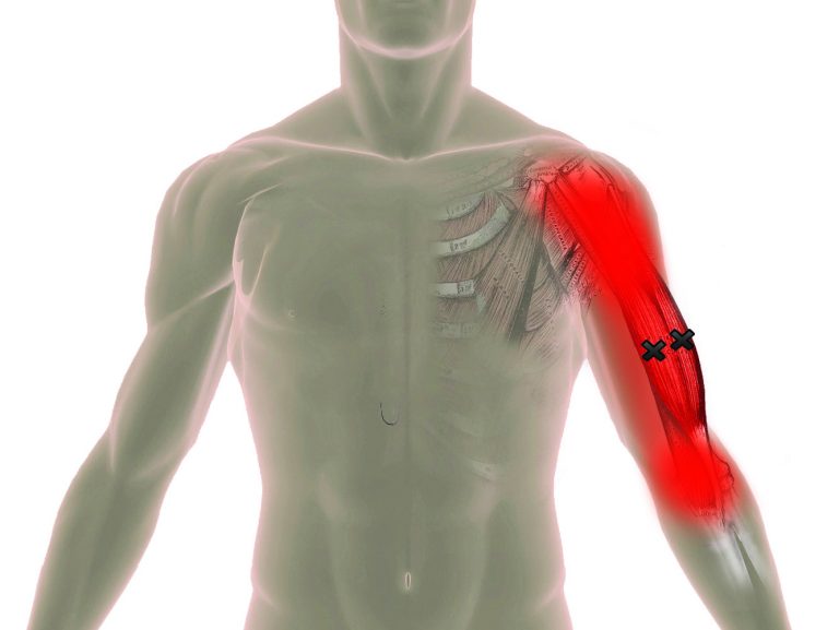 Arm Trigger Points