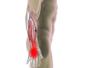 Arm Trigger Points – Life After Pain