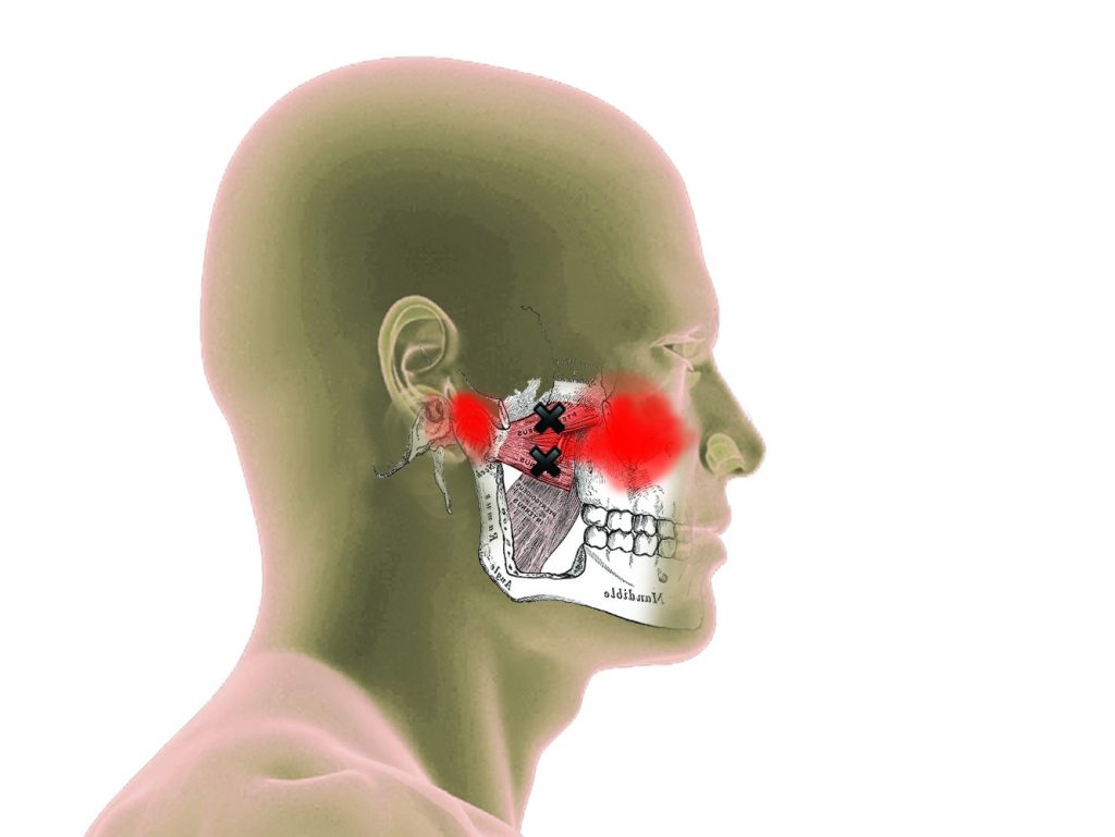 Trigger Point Tooth Pain – an Unusual Cause – Life After Pain