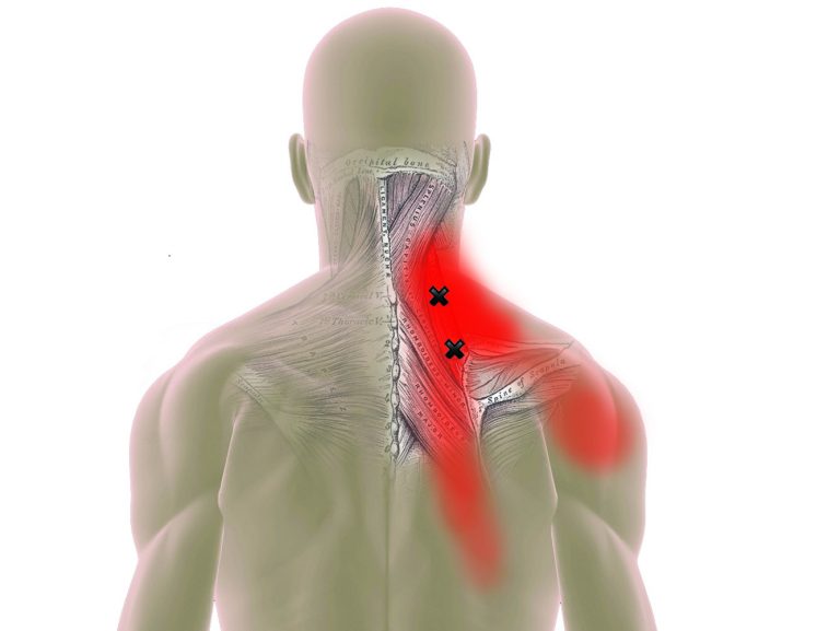 Levator Scapulae Trigger Points – Life After Pain