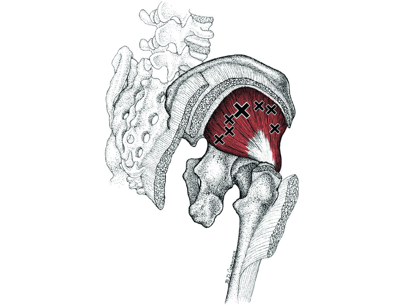 Sciatica Trigger Points – Life After Pain