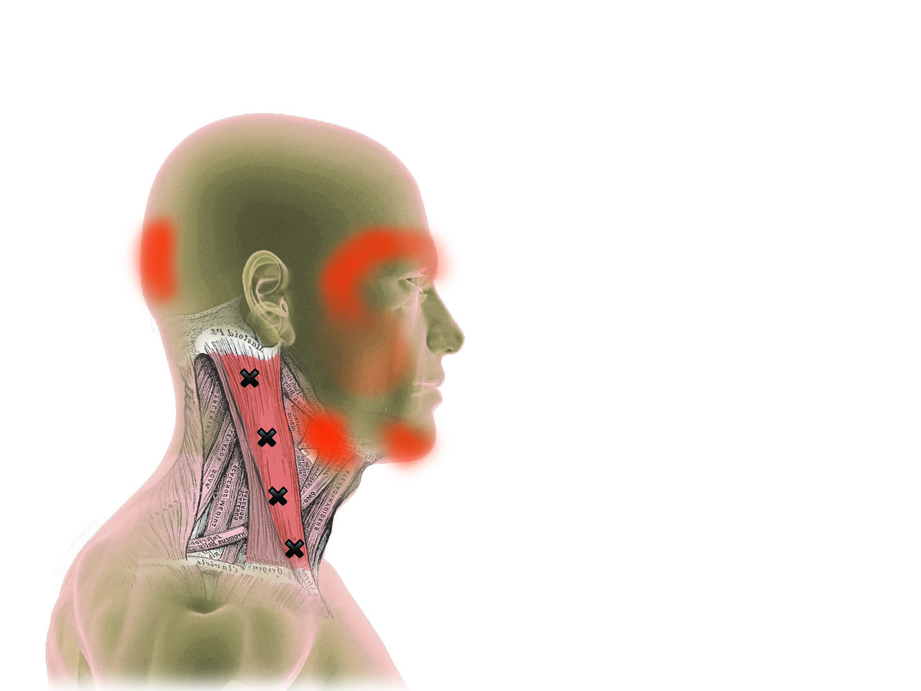 Sternocleidomastoid Trigger Points – Life After Pain